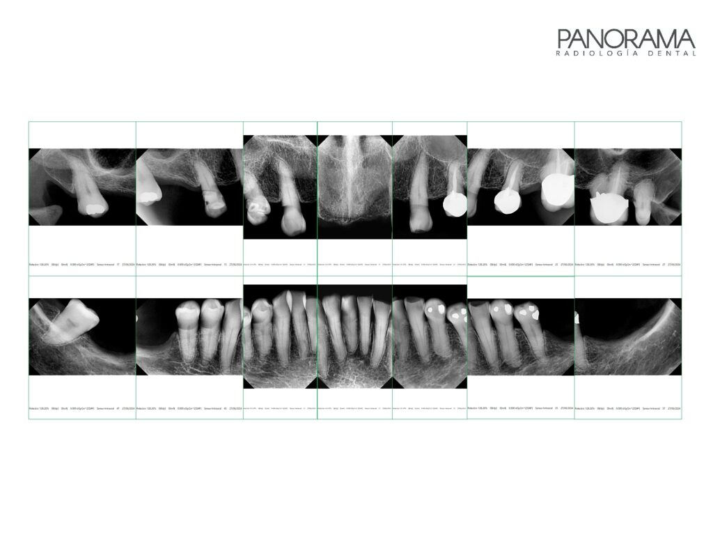 RADIOGRAFIAS INTRAORALES (PERIAPICALES) | Radiología Dental